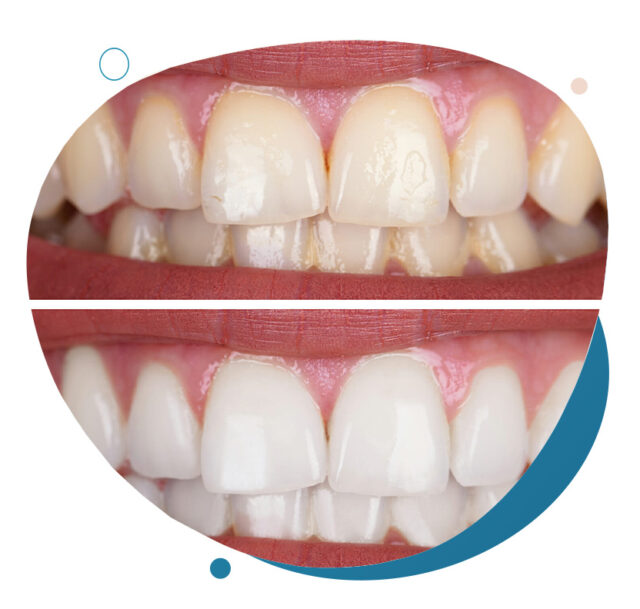 Bleaching – Easy Smile Clinic